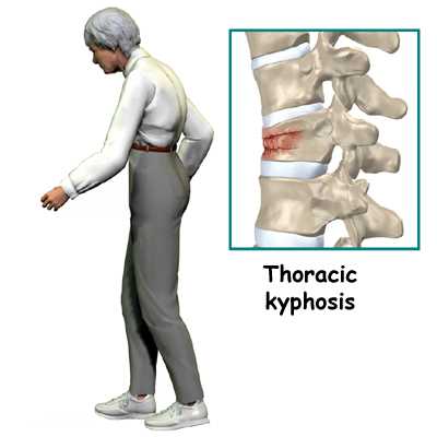 BWK Fraktur oder Kyphose ?? - Skoliose-Info-Forum